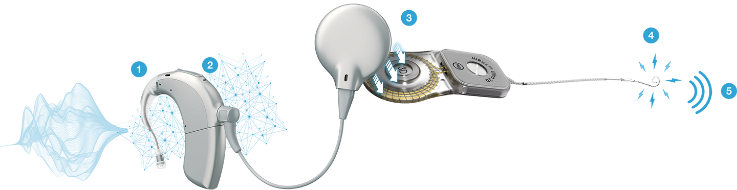 Naída CI Marvel - Pusat Alat Bantu Dengar - Nobel Audiology Center